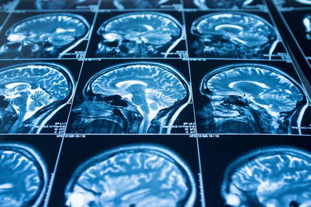 Post-Traumatic Growth: An Introduction - AllPsych